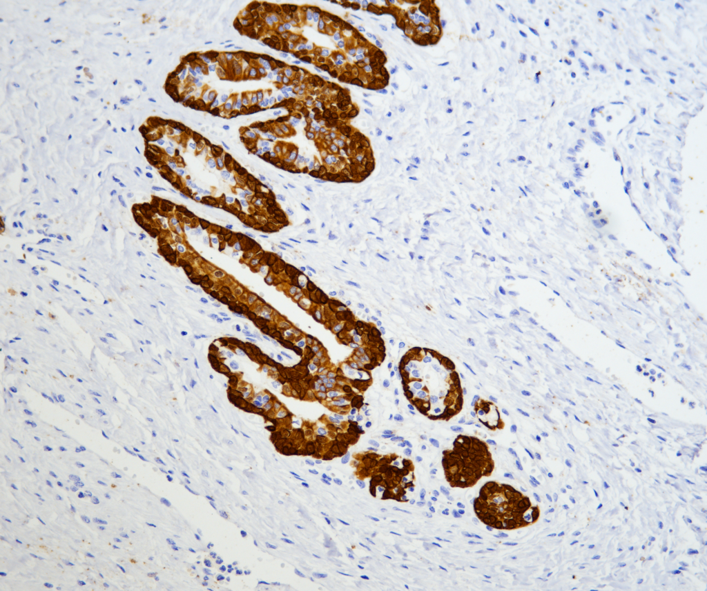 34βE12/P63/AMACR Detection Kit (Immunocytochemistry)