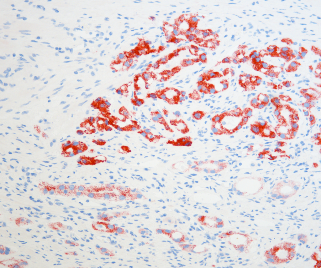 34βE12/P63/AMACR Detection Kit (Immunocytochemistry)