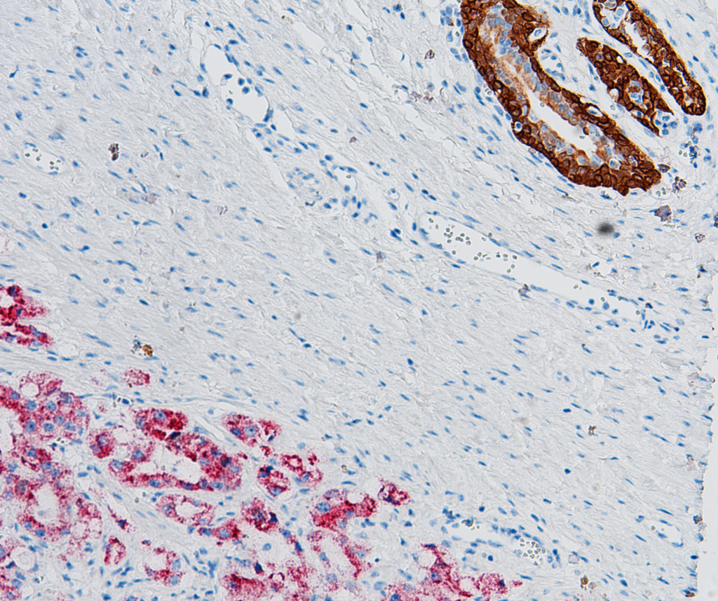 34βE12/P63/AMACR Detection Kit (Immunocytochemistry)