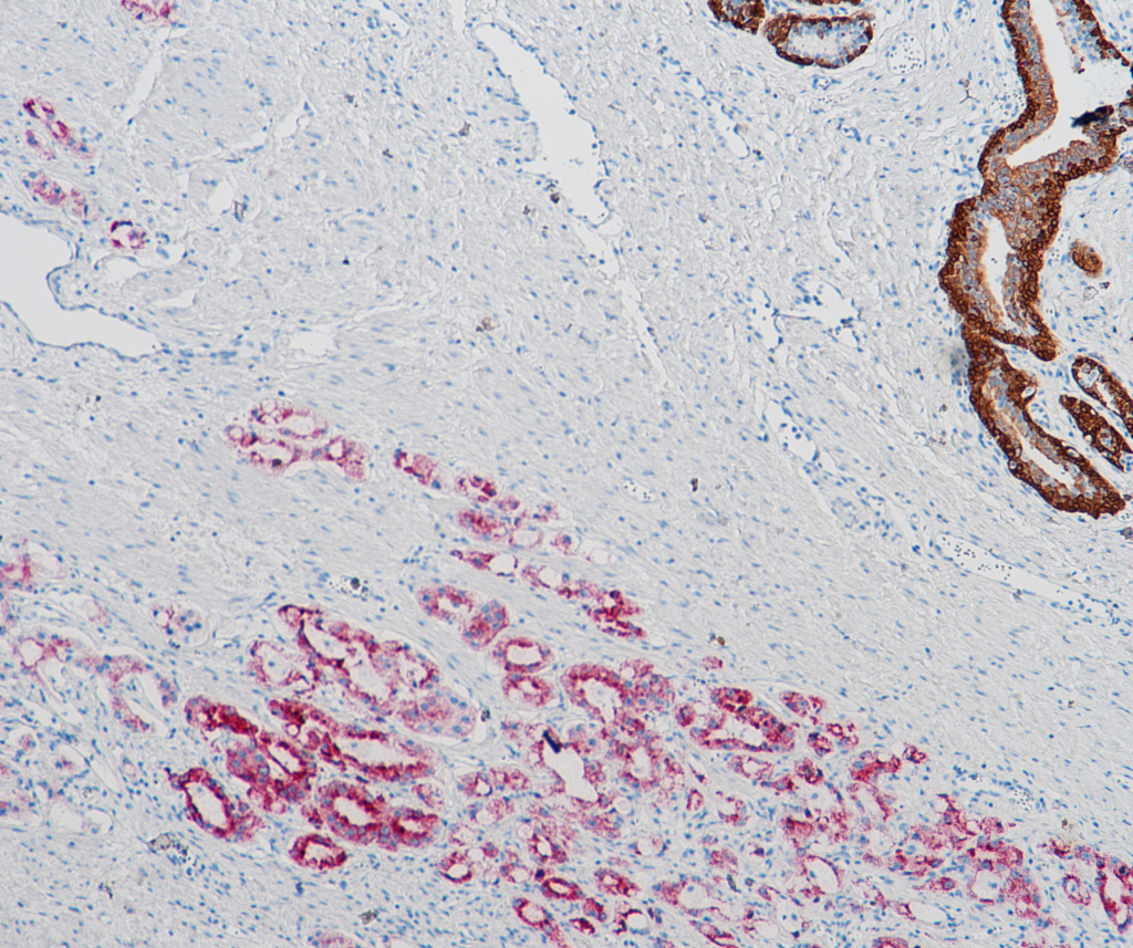 34βE12/P63/AMACR Detection Kit (Immunocytochemistry)