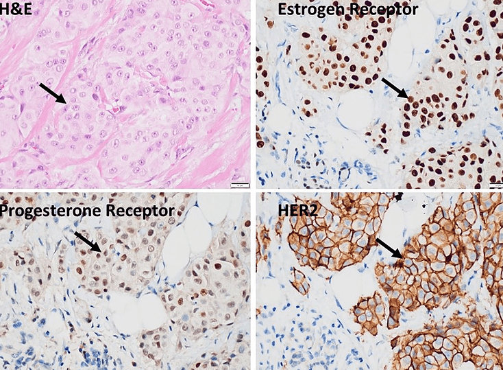 The Meaning of the IHC Markers