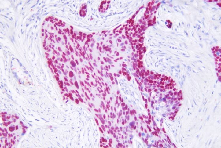 carcinome épidermoïde du poumon p 40 - noyau (rouge)