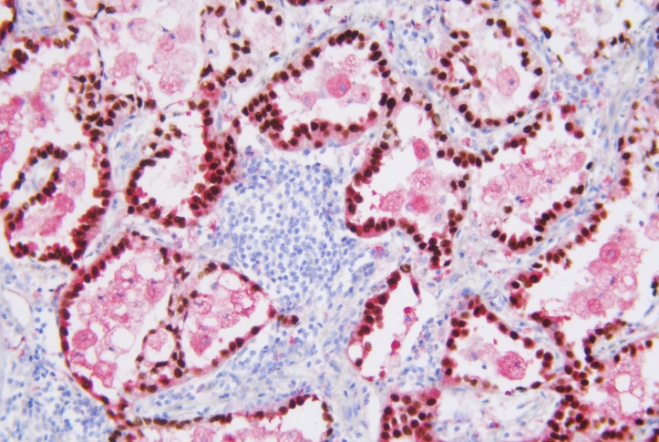 Adénocarcinome pulmonaire TTF-1- noyau (marron)