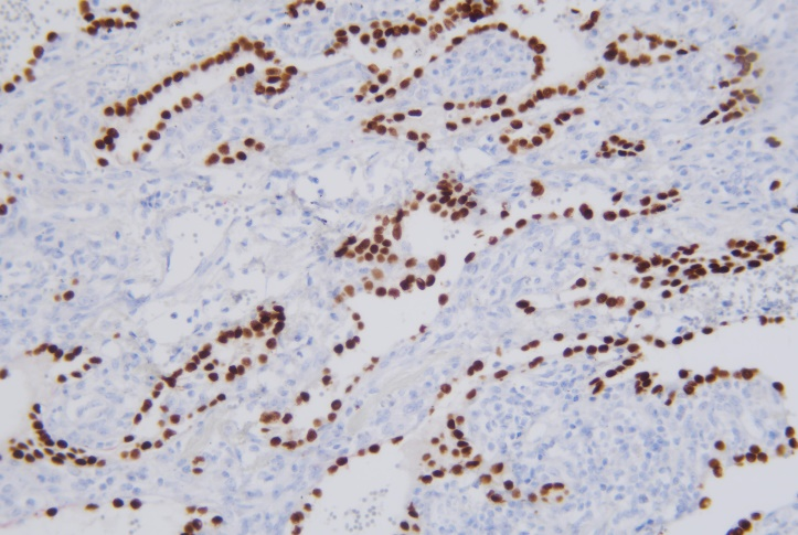 CK5/6/TTF-1 detection reagent (Immunohistochemical)