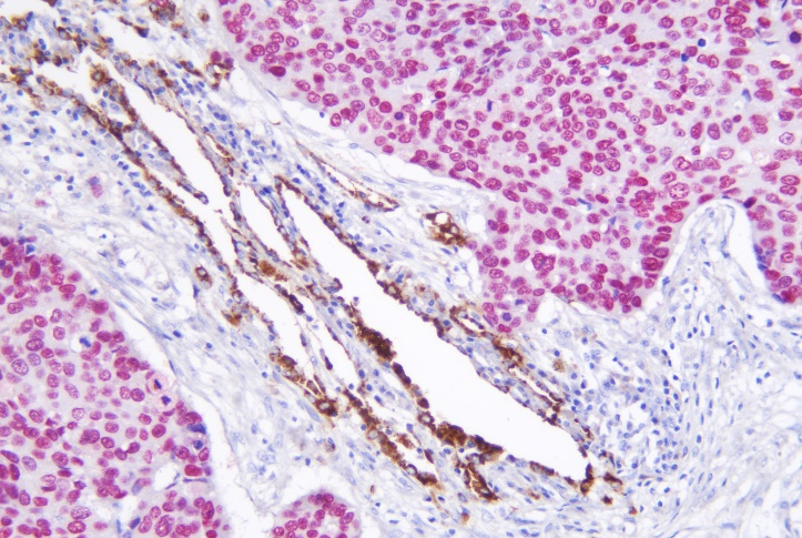 carcinome épidermoïde du poumon Napsine A-cytoplasme ((marron)