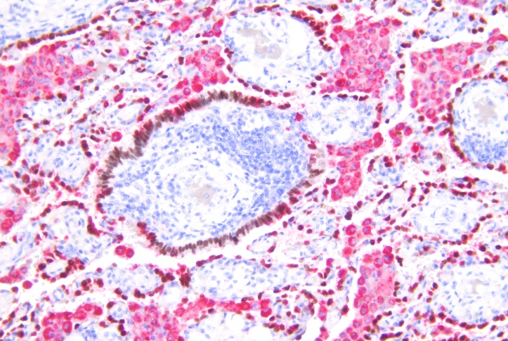 N apsineA- adénocarcinome pulmonaire- cytoplasme (brunes)