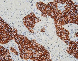 What Does "IHC Positive" Really Mean for Your Diagnosis?