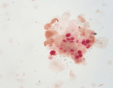 Ki-67 Essentials for Lab Technicians: Accurate Scoring